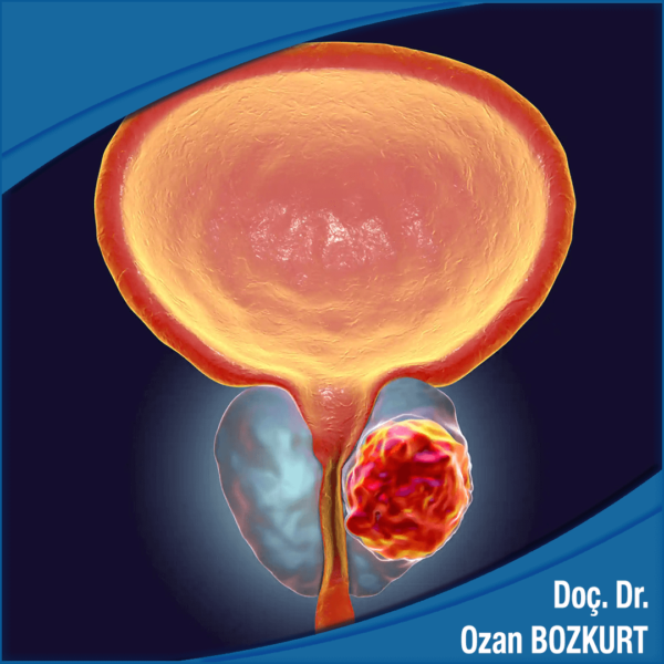 PROSTAT KANSERİ | Üretra Darlığı, DOÇ. DR. OZAN BOZKURT